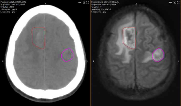 An easier way to realize MR Sim with CT facilitie