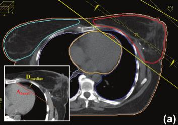 Prone Patient Immobilization Solution for Breast Cancer