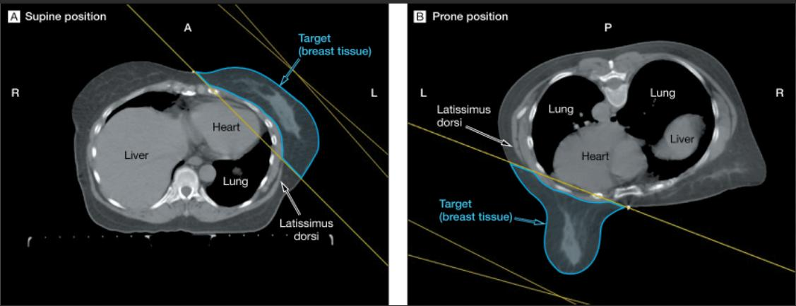 Prone Patient Immobilization Solution for Breast Cancer